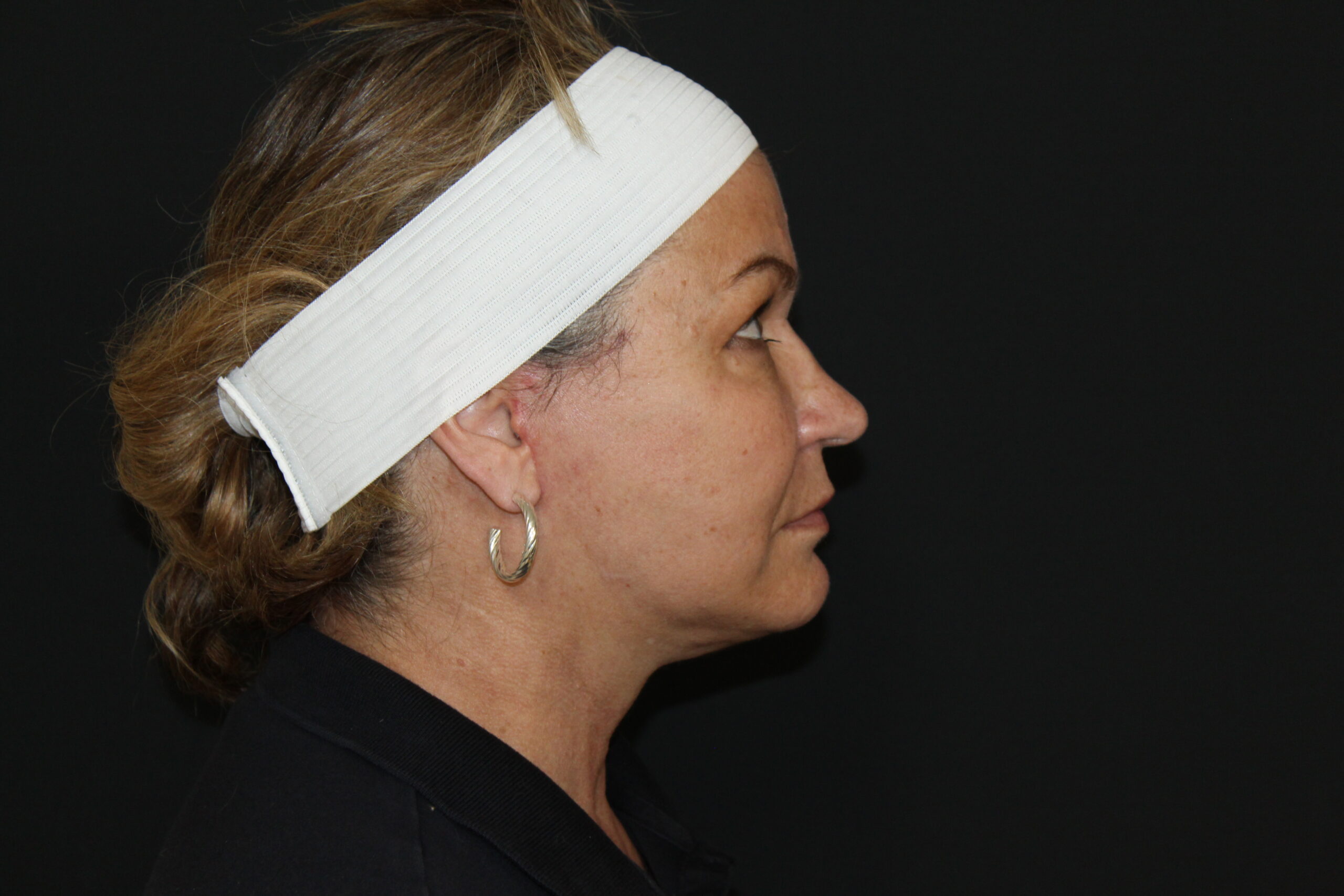 Patient3_lef_profile_after - Cape & Islands Plastic Surgery